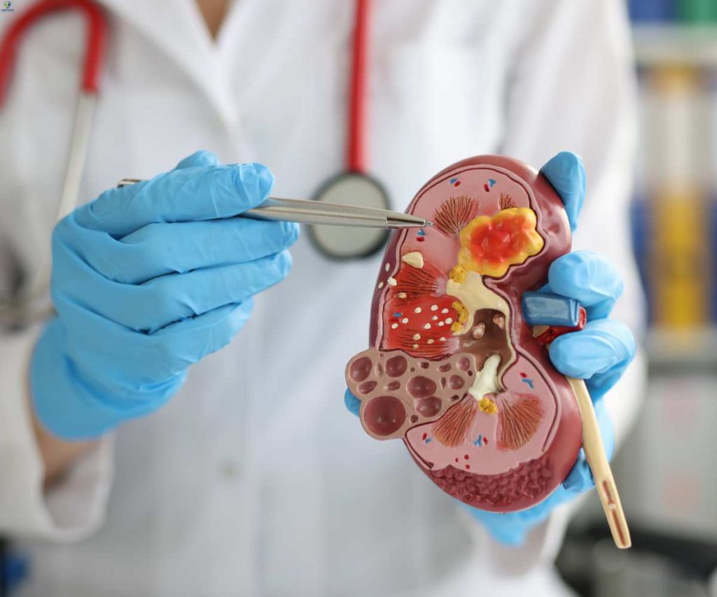 Cancer of the Kidney – Lakeview Center for Urology