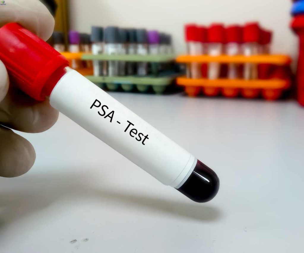 Elevated PSA – Lakeview Center for Urology